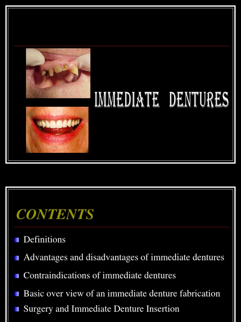 Immediate Denture Guide | PDF | Dentures | Mouth