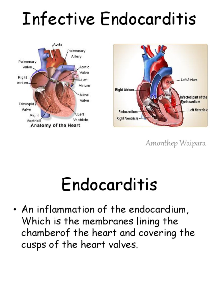 Infective Endocarditis | Streptococcus | Public Health
