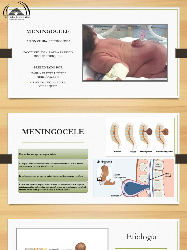 Meningocele PDF | PDF | Medicina | Enfermedades y trastornos