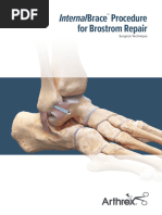 Brostrom Repair with InternalBrace Guide | PDF | Foot | Anatomical ...