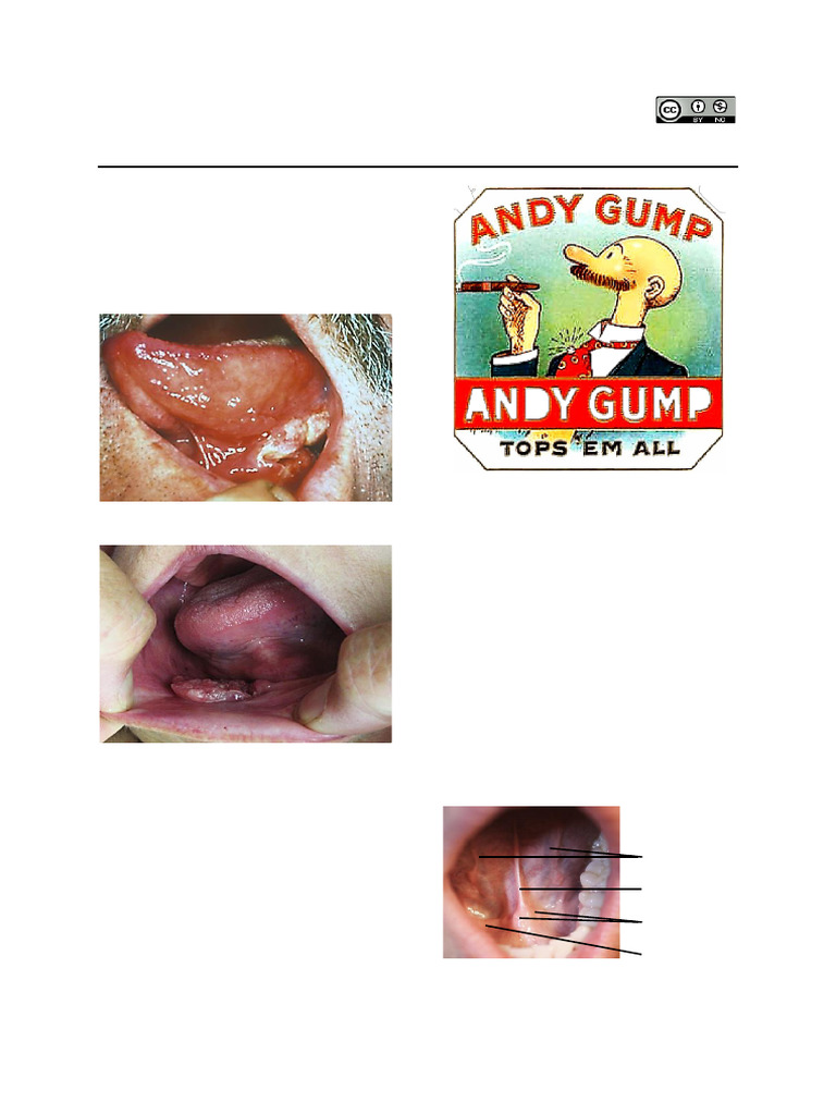 Resection of Floor of Mouth Cancers | PDF | Mouth | Human Head And Neck