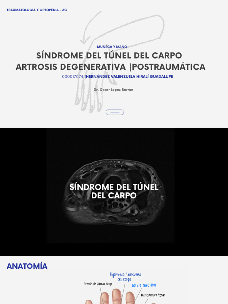 STC y Artrosis Muñeca y Mano-4 | PDF | Síndrome del túnel carpiano ...