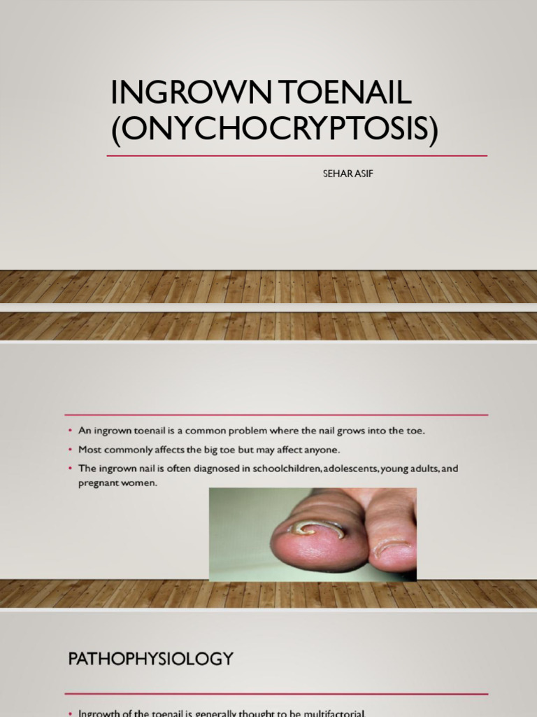 Ingrown Toenail (Onychocryptosis) : Sehar Asif | PDF