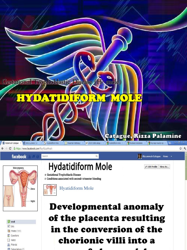 Hydatidiform Mole | Fetus | Pregnancy
