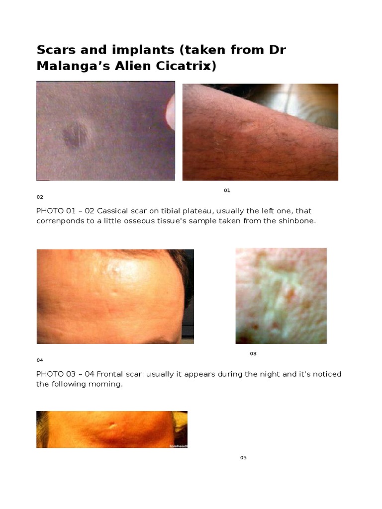 Alien Cicatrix (Part 03 of 06) - Scars and Implants On Abductees | PDF