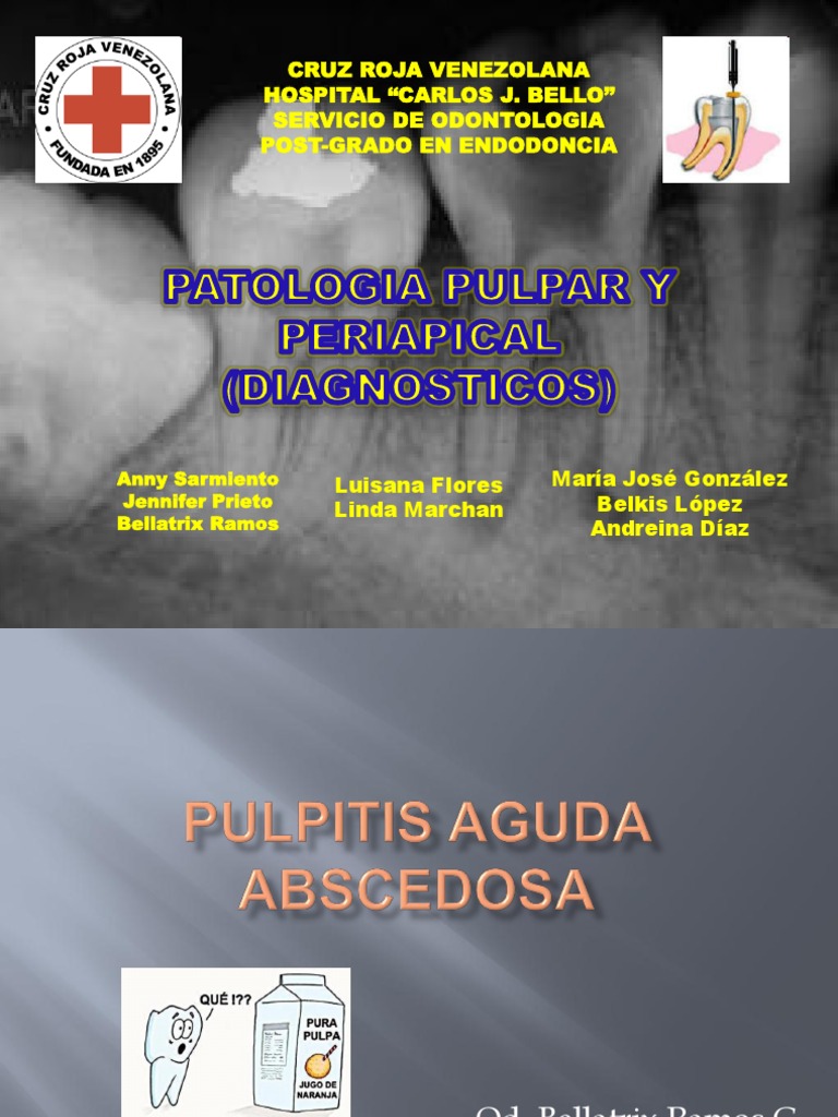 Pulpitis aguda abscedosa
