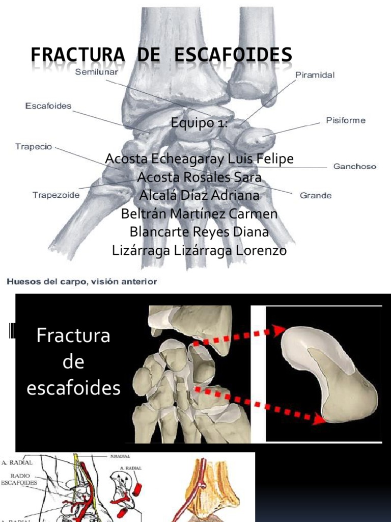 Fractura de Escafoides | PDF | Mano | Medicina