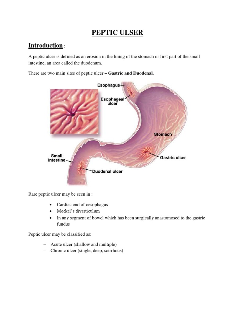 Peptic Ulser | PDF | Peptic Ulcer | Stomach