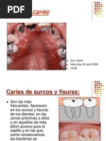 Etapas y Grados de Caries PDF | PDF | Diente | Odontología