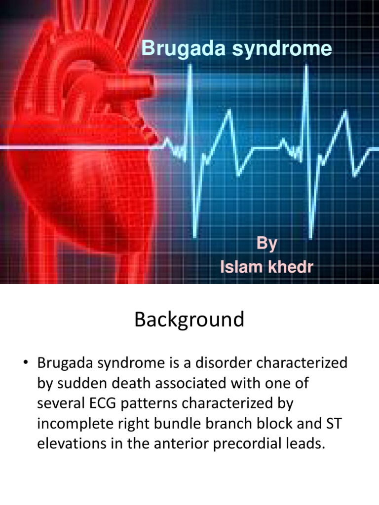 Brugada Syndrome | PDF | Cardiac Arrest | Electrocardiography