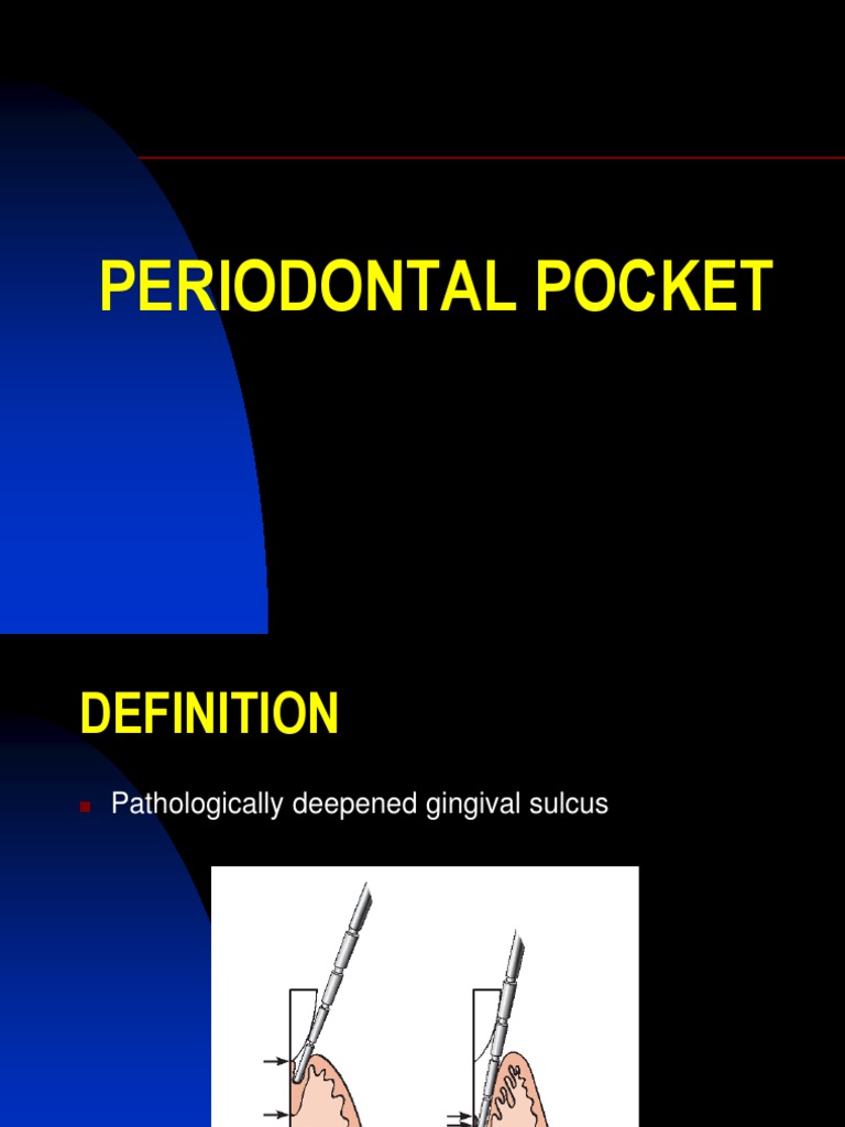 1 - The Periodontal Pocket | PDF | Inflammation | Dentistry Branches