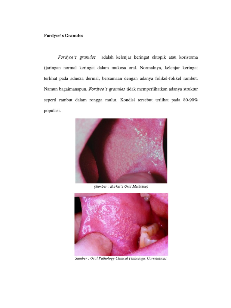 Fordyce's Granules | PDF