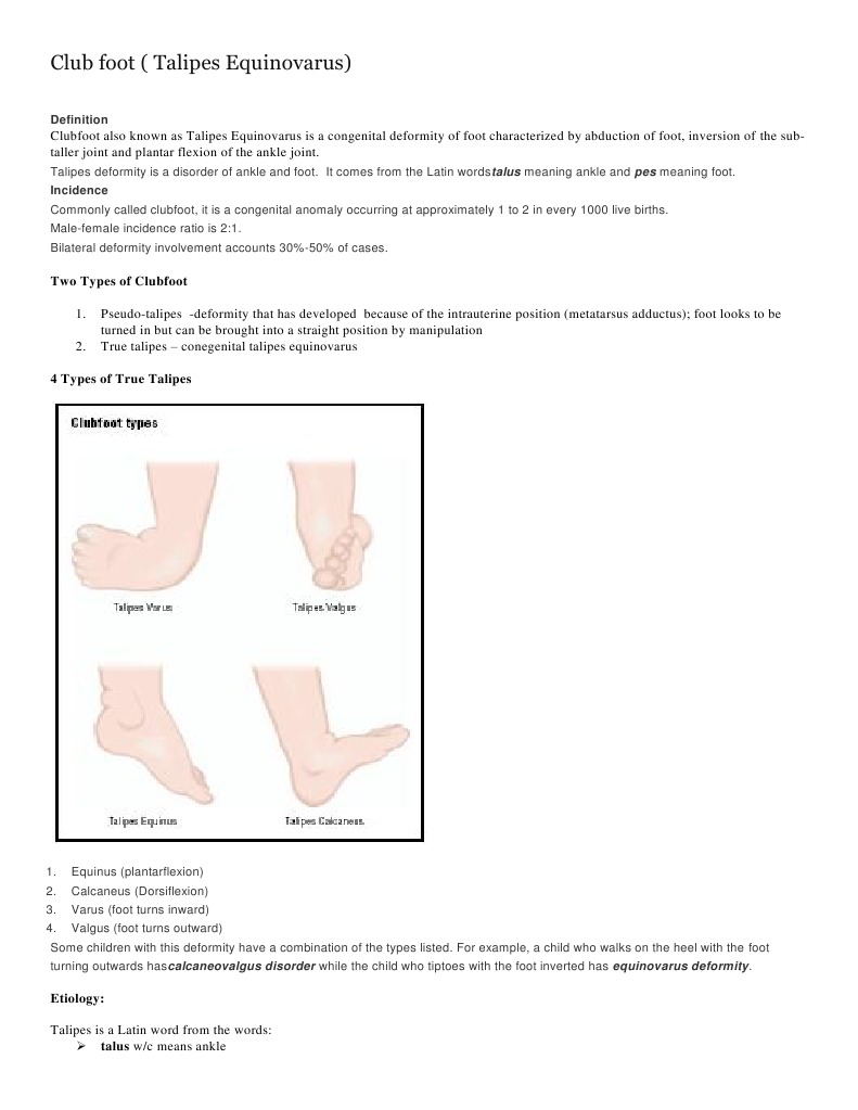 Club foot | Foot | Musculoskeletal System