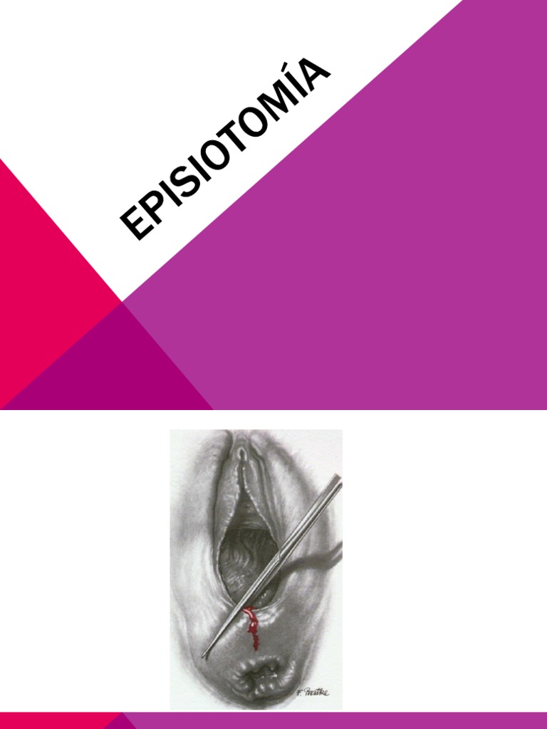 Episiotomía: Tipos y Complicaciones | PDF | Vagina | Parto