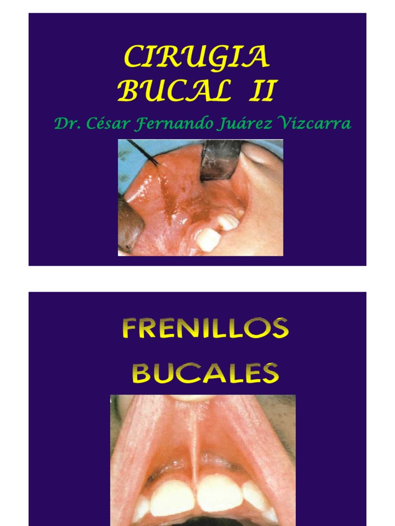 Clasificación y tipos de frenillos bucales | PDF | Lengua | Músculo