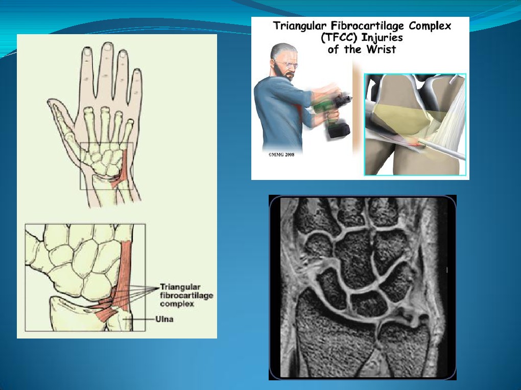TFCC | Musculoskeletal System | Limbs (Anatomy)