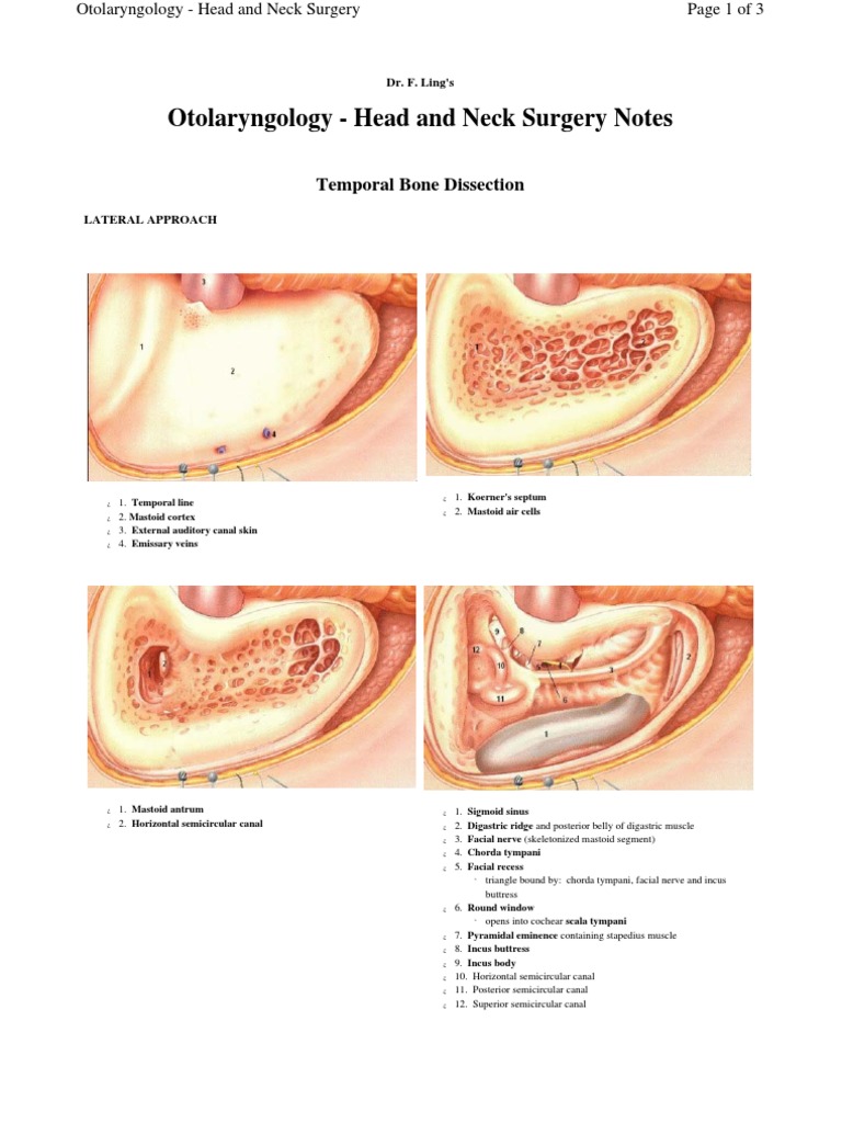 Temporal Bone Dissection Lateral Approach | PDF | Auditory System | Human Head And Neck