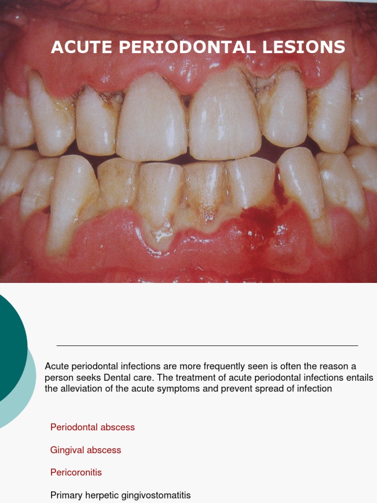 ACUTE PERIODONTAL LESIONS | PDF | Dentistry | Dentistry Branches