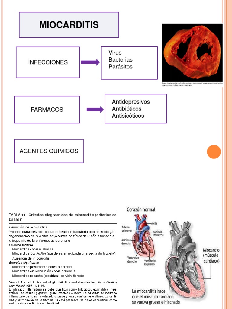 MIOCARDITIS | PDF | Inflamación | Inmunología