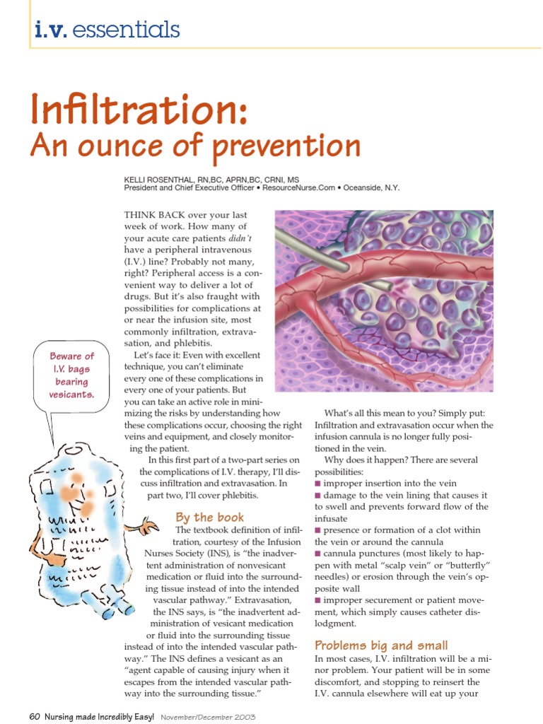 IV Infiltration | PDF | Intravenous Therapy | Medicine