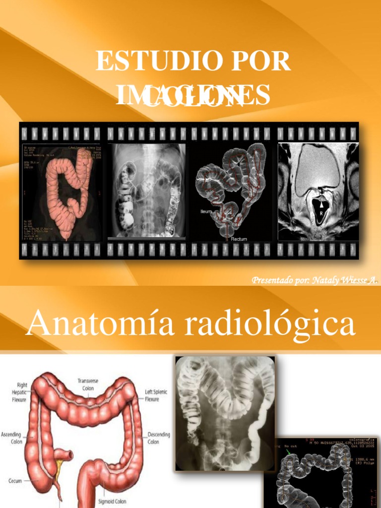 Estudio Radiológico del Colon | PDF | Ct Scan | Cáncer colonrectal