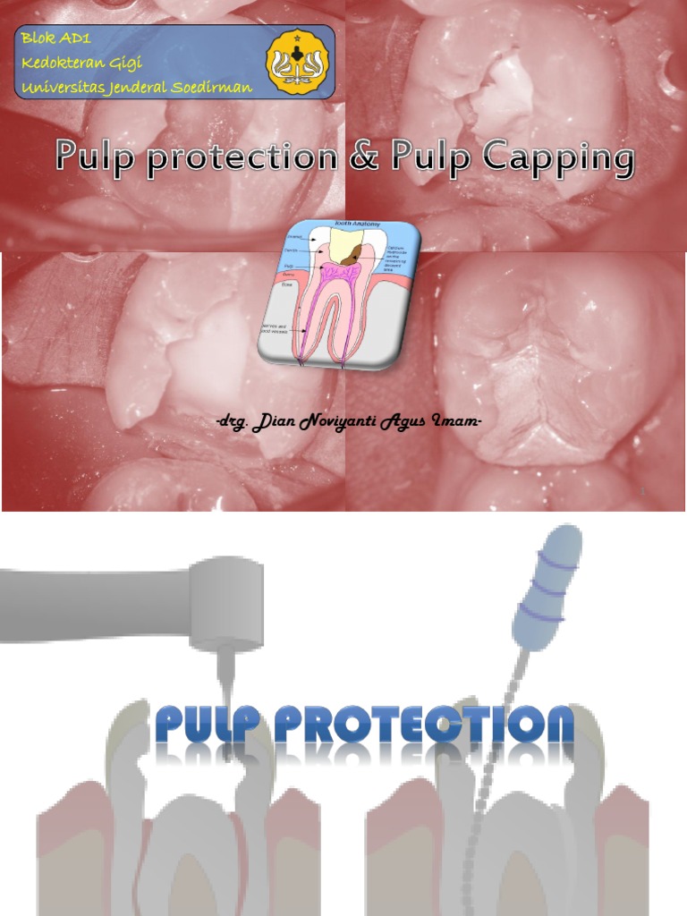L 3pulp Protection Pulp Capping | PDF