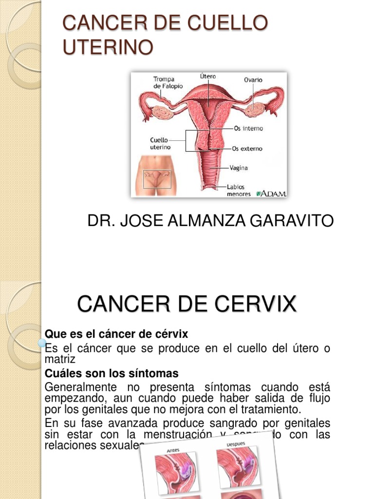 Cancer de Cervix | PDF | Cáncer de cuello uterino | La salud de la mujer