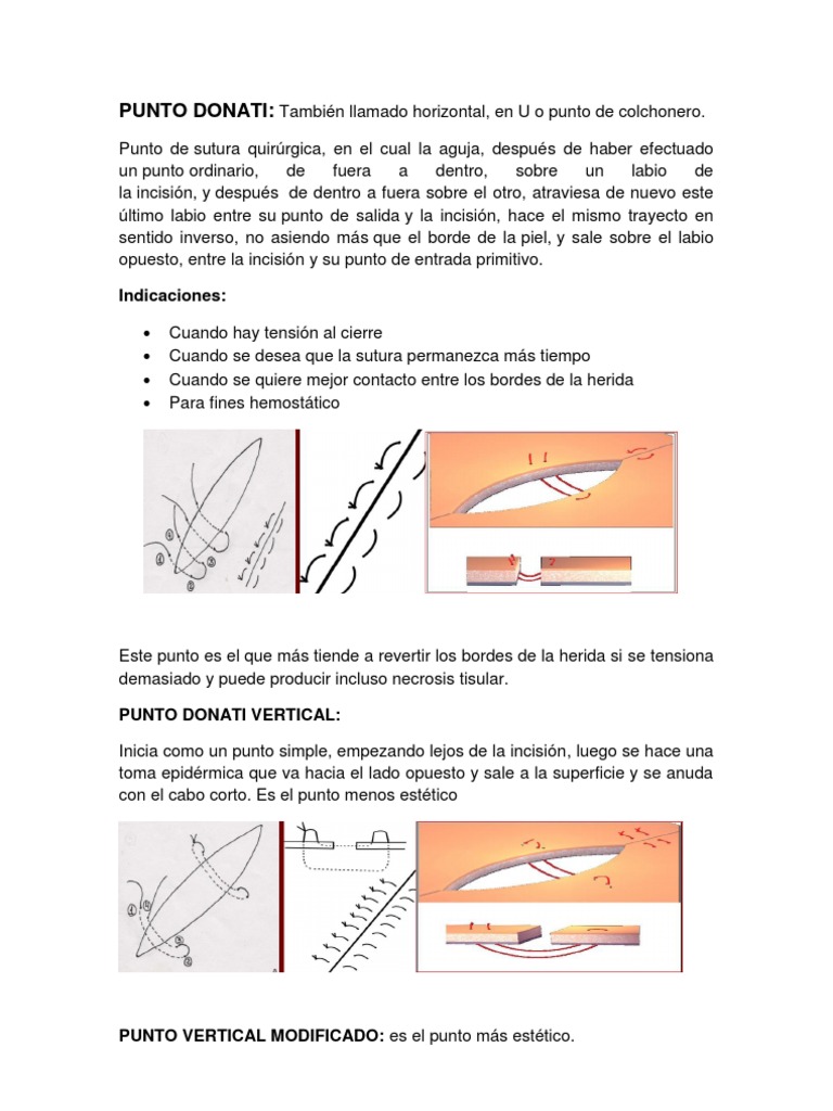 Técnicas de Sutura Donati y Puntos en X | PDF