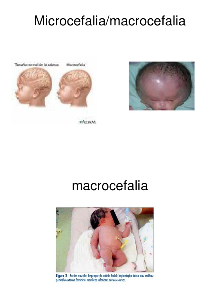 Microcefalia | PDF | Salud y bienestar