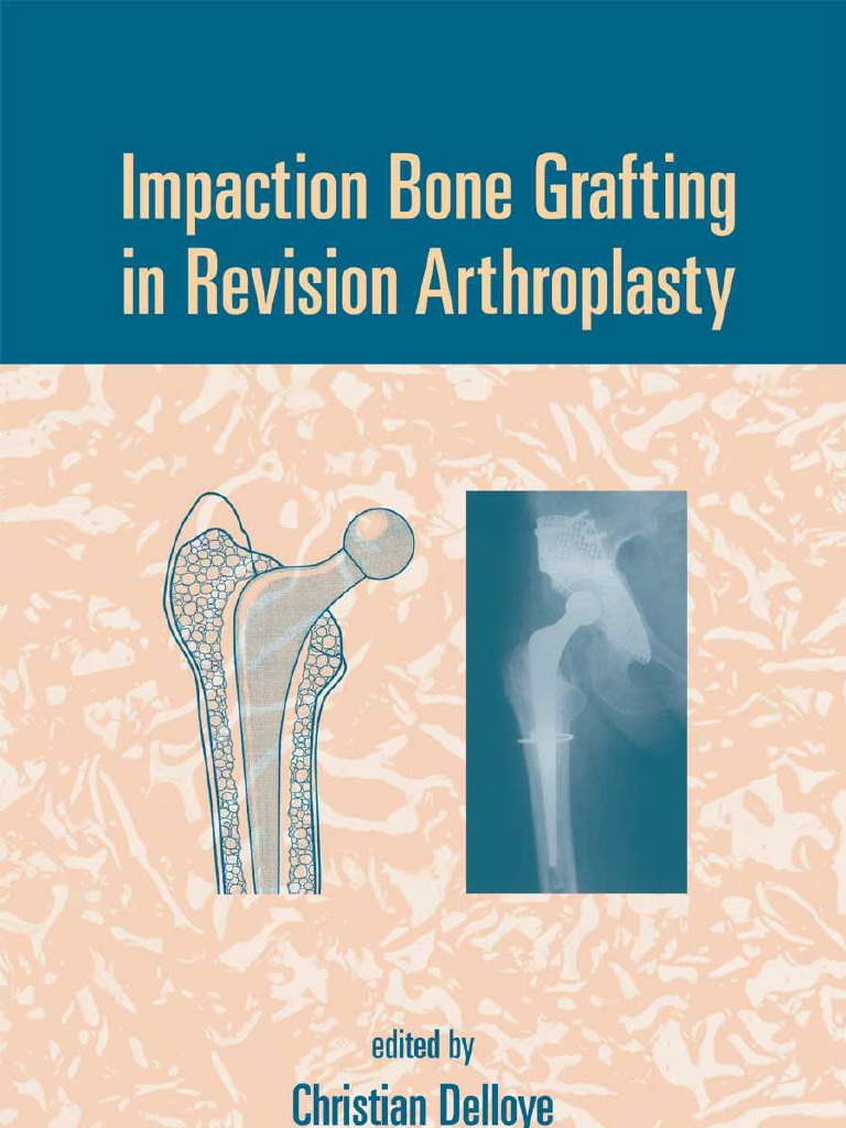 Impaction Bone Grafting in Revision Arthroplasty - C. Delloye, G ...
