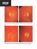 Screendem P KIrwan Spondyloarthropathy | PDF