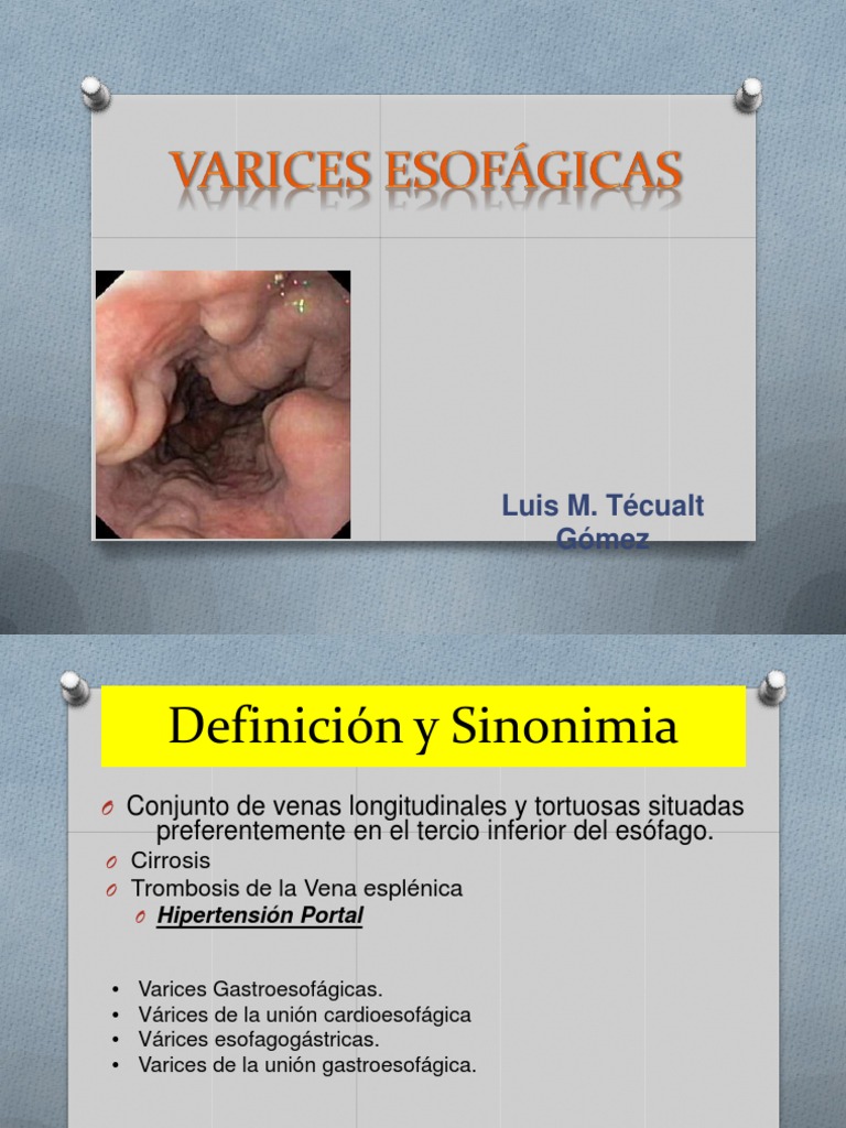 Varices Esofágicas | Estómago | Especialidades Medicas