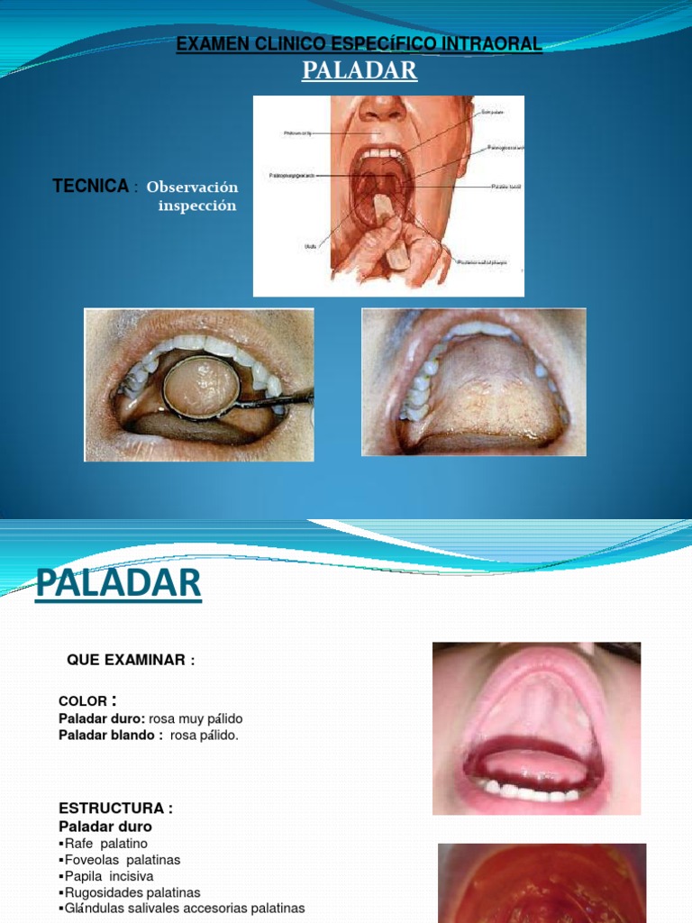 Anatomía Del Paladar Duro Bultos En El Paladar, ¿a Qué Pueden