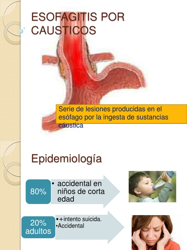 Esofagitis Por Causticos | PDF | Inflamación | Septicemia