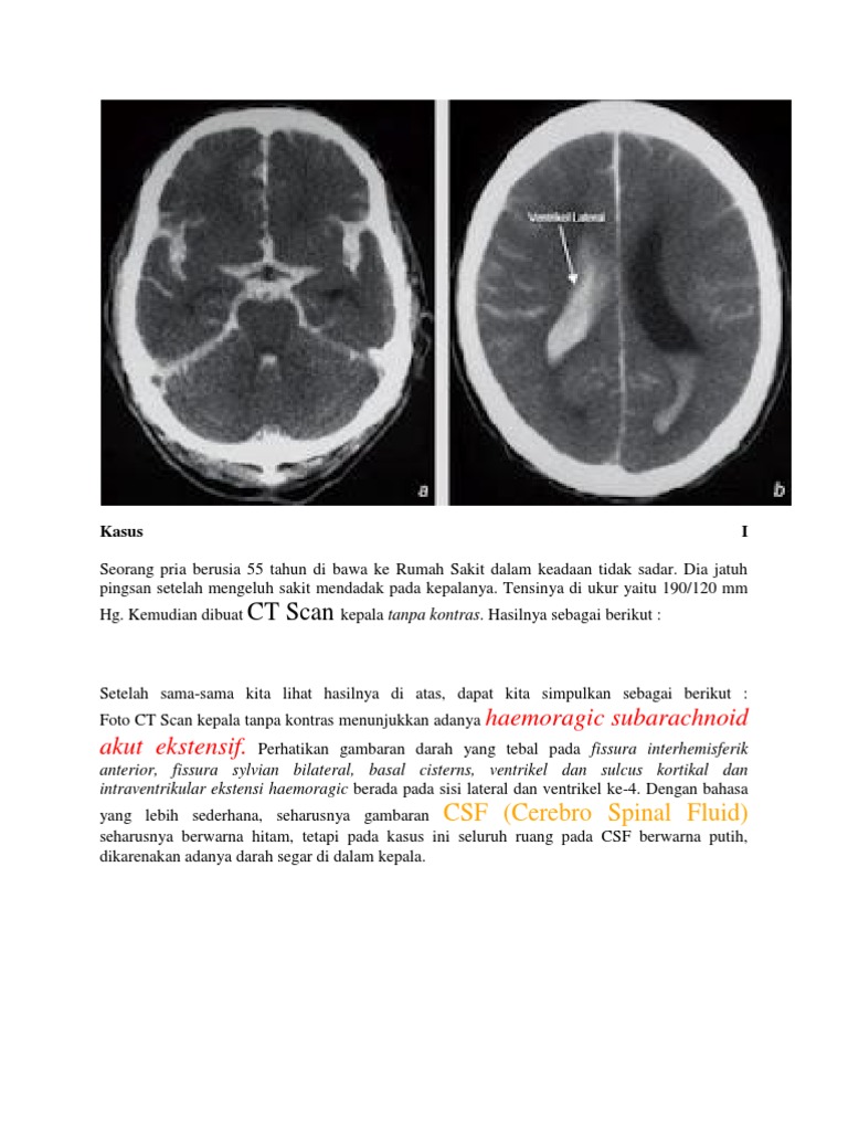 CT Scan | PDF | Neurotrauma | Neuroanatomi