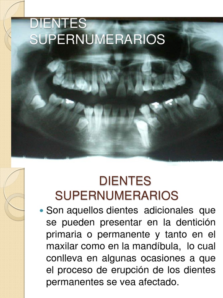 Dientes Supernumerarios | Diente humano | Diente | Prueba gratuita de ...