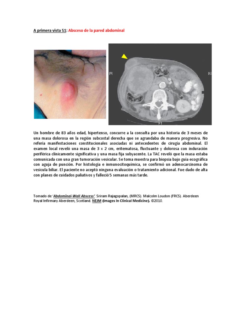 A Primera Vista 51 (Absceso de La Pared Abdominal) | PDF | Ciencia y ...