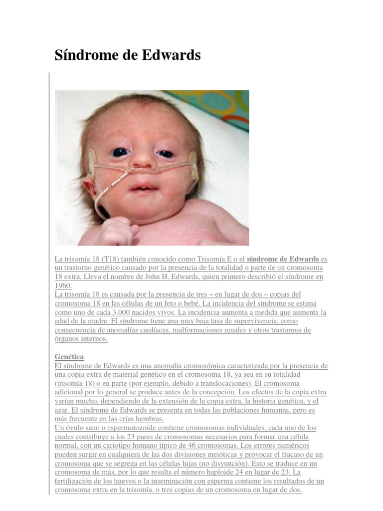 Síndrome de Edwards: Trisomía 18 Explicada | PDF | Nucleo celular ...