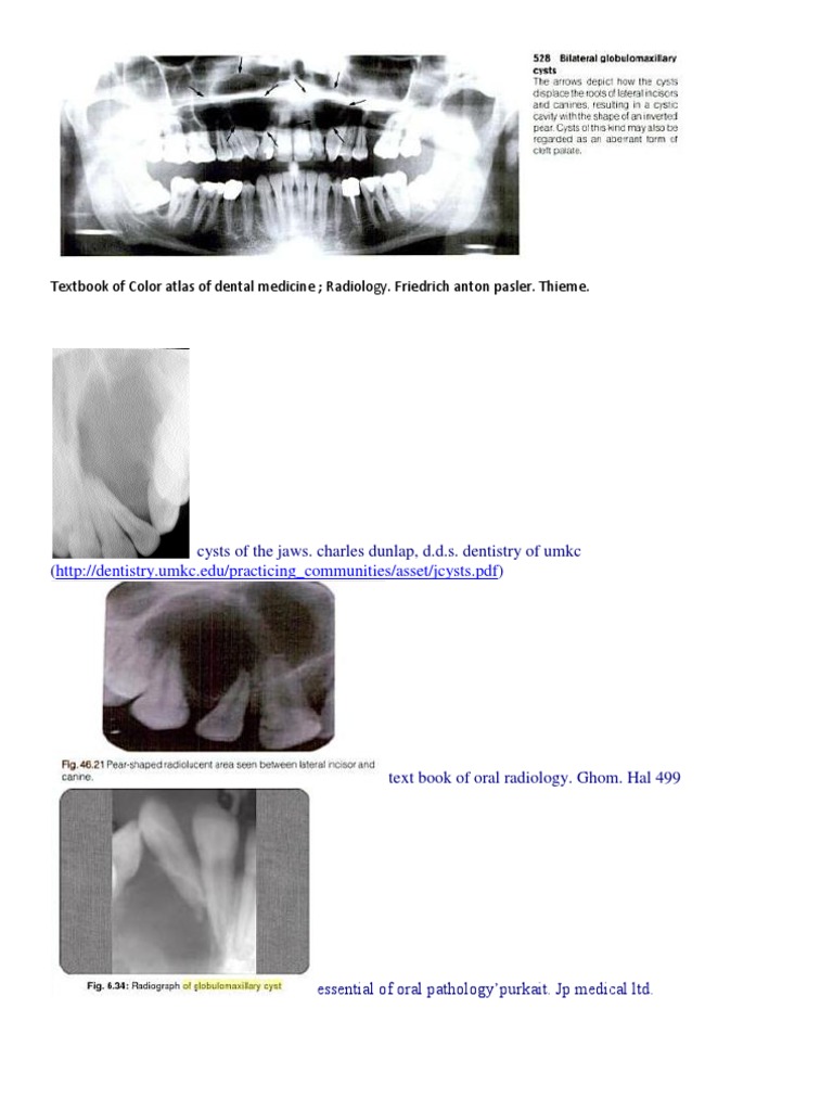 Globulomaxillary Cyst in Dental Radiology | PDF