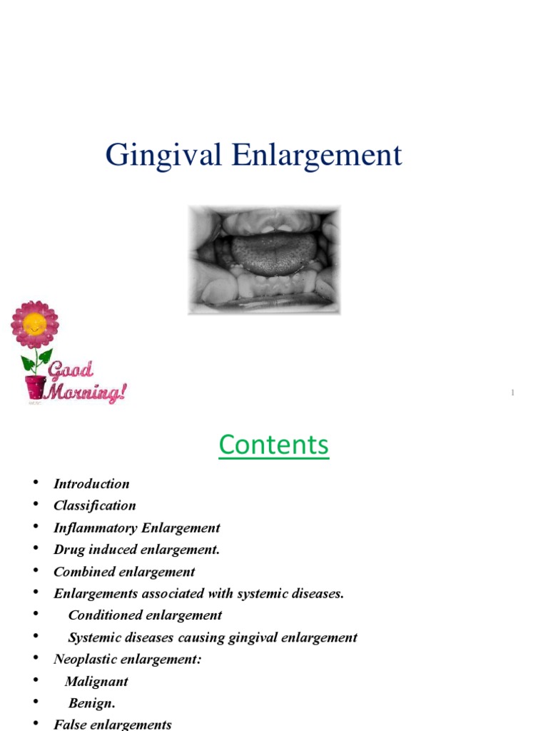 Classification of Gingival Enlargement | PDF | Neoplasms | Epithelium