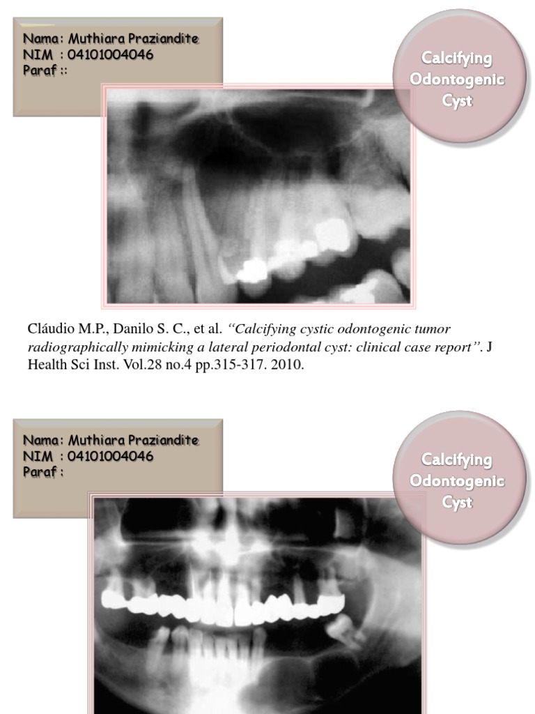 Calcifying Odontogenic Cyst | PDF