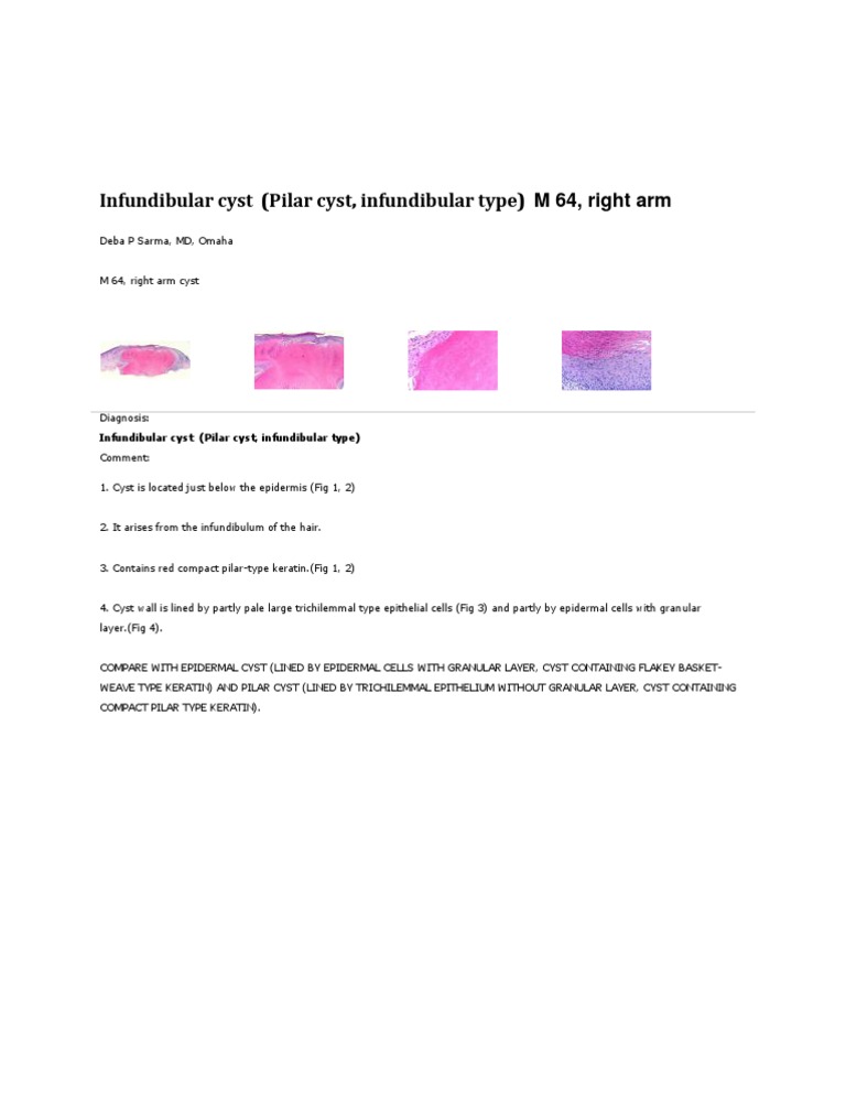 Infundibular Cyst Diagnosis and Features | PDF | Epithelium | Epidermis