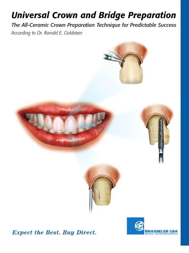 Universal Crown and Bridge Preparation | PDF | Home & Garden | Science ...