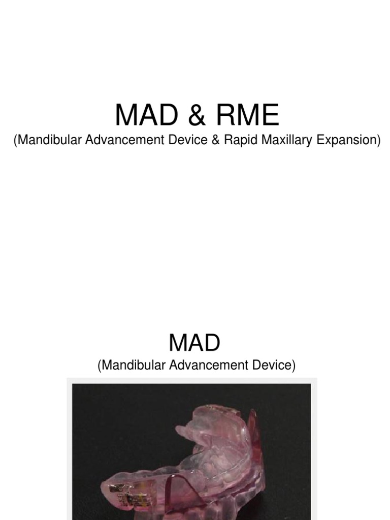 Mandibular Advancement Device & Rapid Maxillary Expansion | Snoring ...