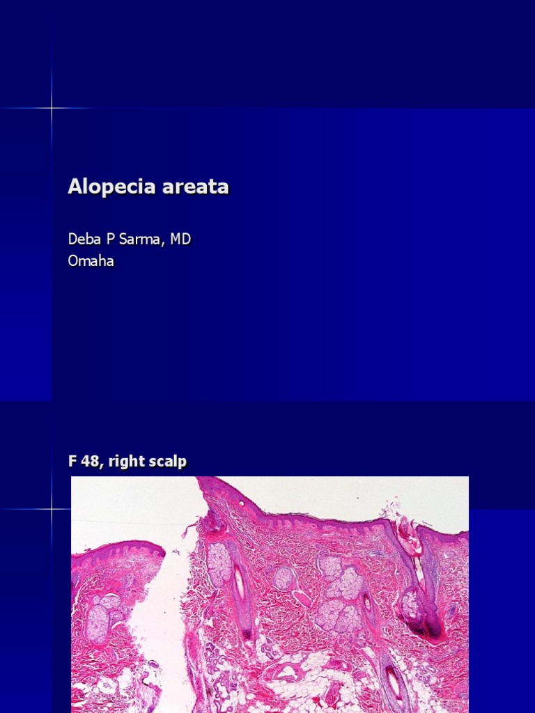 Alopecia Areata Diagnosis Insights | PDF