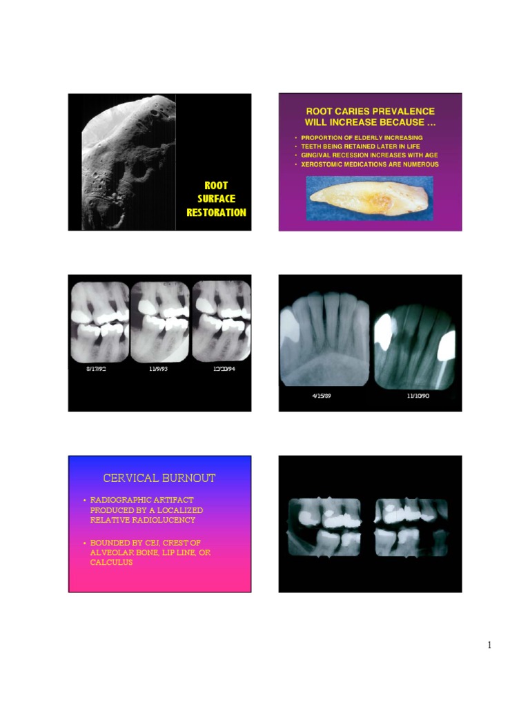 Root Surface Restoration: Cervical Burnout | PDF