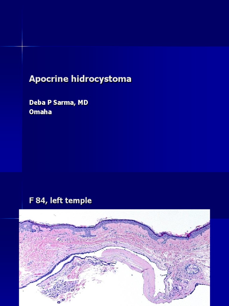Apocrine Hidrocystoma Overview | PDF | Science & Mathematics