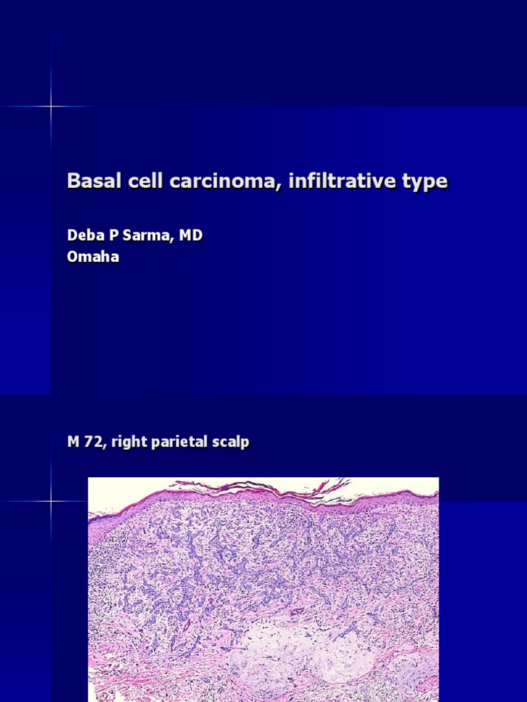 Basal Cell Carcinoma, Infiltrative Type. M 72, Scalp | PDF