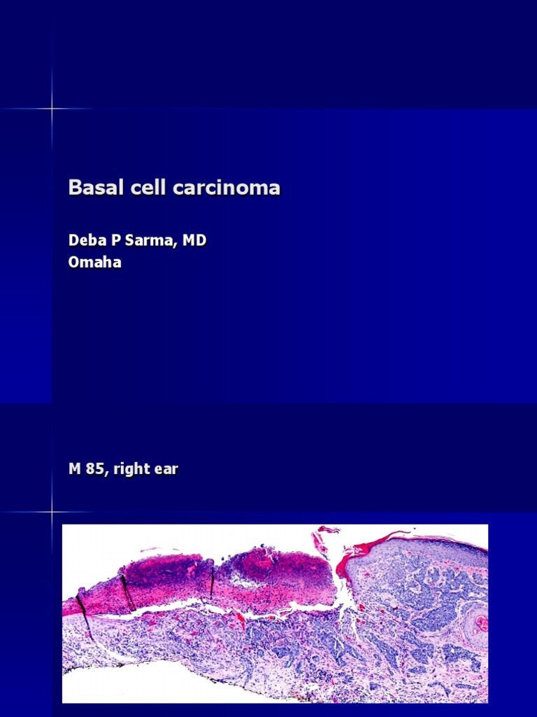 Basal Cell Carcinoma, M 85, Right Ear | PDF | Endocrine System ...