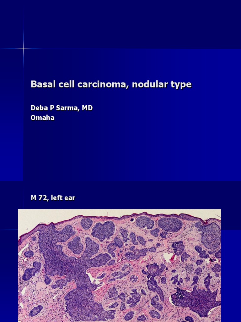 Basal Cell Carcinoma, Nodular Type: Deba P Sarma, MD Omaha | PDF